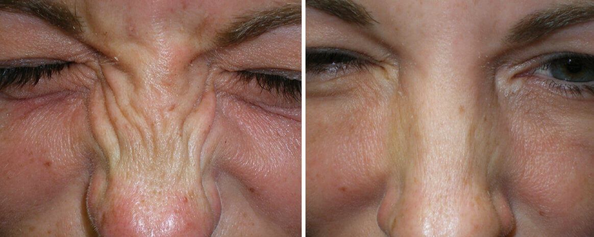Botox | Wrinkles | TBL Manila